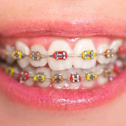 Los peligros de colocarse brackets falsos. Riesgos brackets falsos.